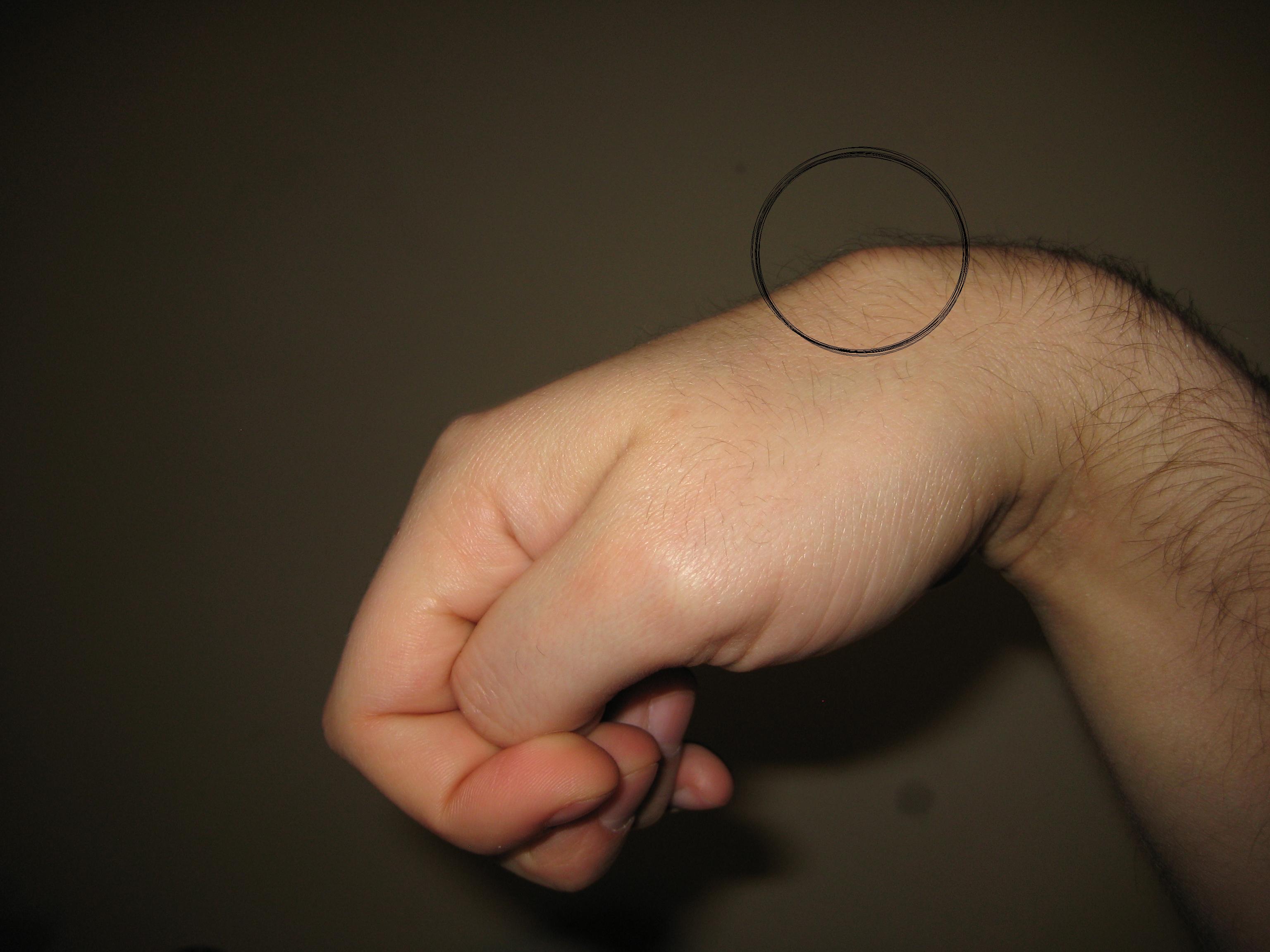 Back Of Hand Lump